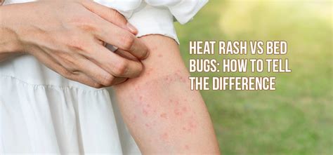 Rash vs Bed Bugs Symptoms - Cloud Console